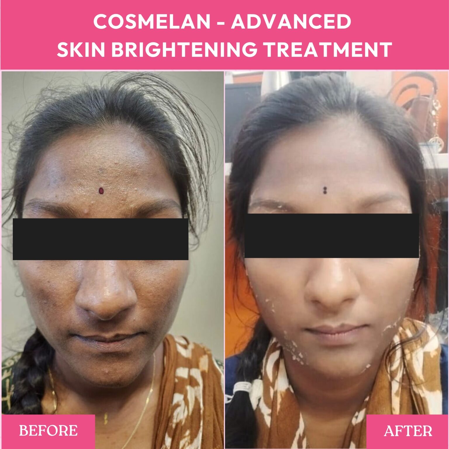 Best Pigmentation Treatment - Cosmelan Peel Before & After Results